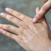 Permanent Effects Of Accident Burn Injuries